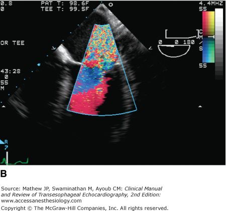 TEE in the Emergency Department | Anesthesia Key