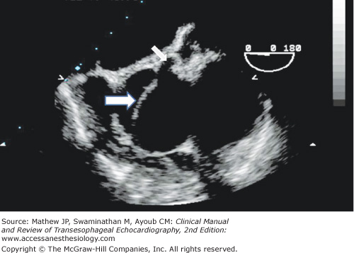 TEE in the Emergency Department | Anesthesia Key