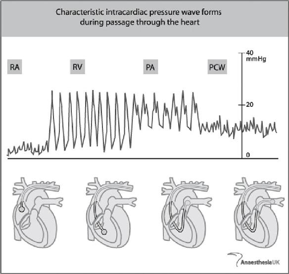 Vascular Cannulation | Anesthesia Key