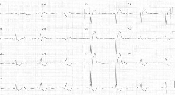 Cardiac Dysrhythmias | Anesthesia Key