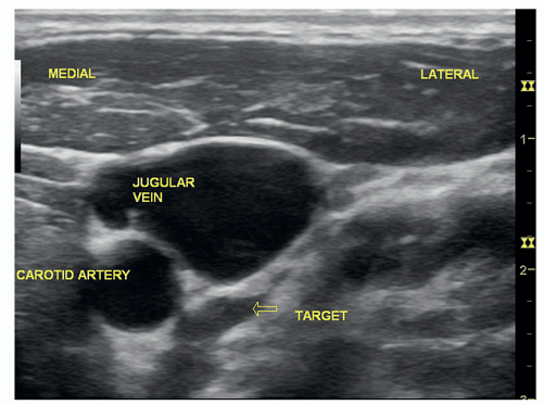 Ultrasound-Guided Pectoral Plane Nerve Block—PECS II | Anesthesia Key