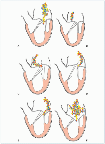 Mitral Valve Repair | Anesthesia Key