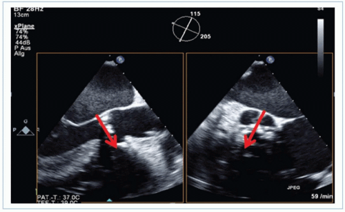 Intraprocedural Echocardiographic Guidance for Transcatheter ...