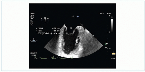 Left Ventricular Systolic Performance and Pathology | Anesthesia Key
