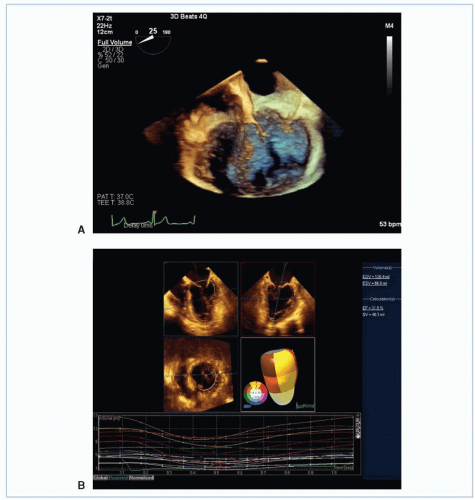 Left Ventricular Systolic Performance and Pathology | Anesthesia Key
