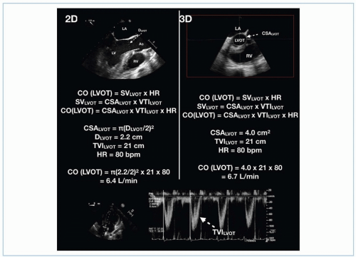 Quantitative Doppler and Hemodynamics | Anesthesia Key