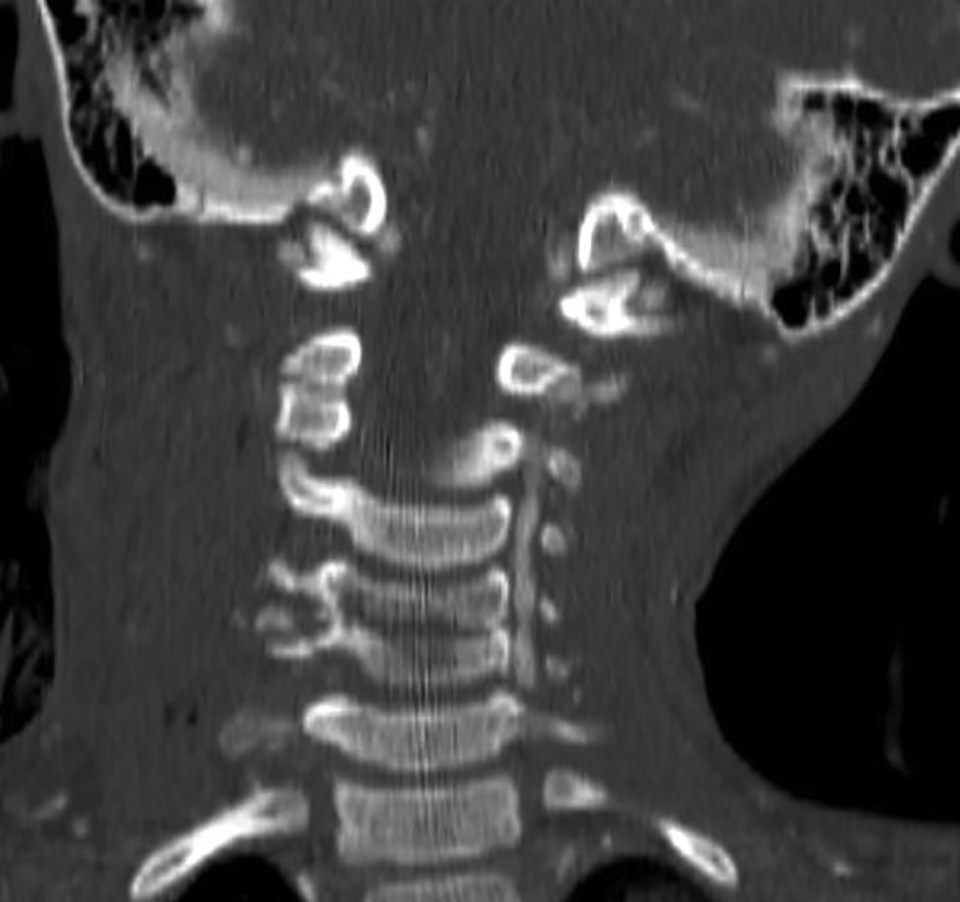 Neck Trauma | Anesthesia Key