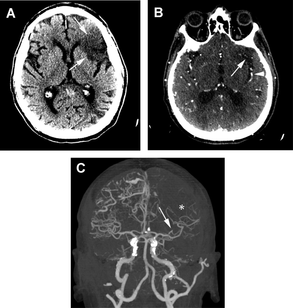 Modern Neuroimaging Techniques in Diagnosing Transient Ischemic Attack ...