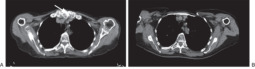 Intrathoracic Tumors: Current Status and Classification | Anesthesia Key