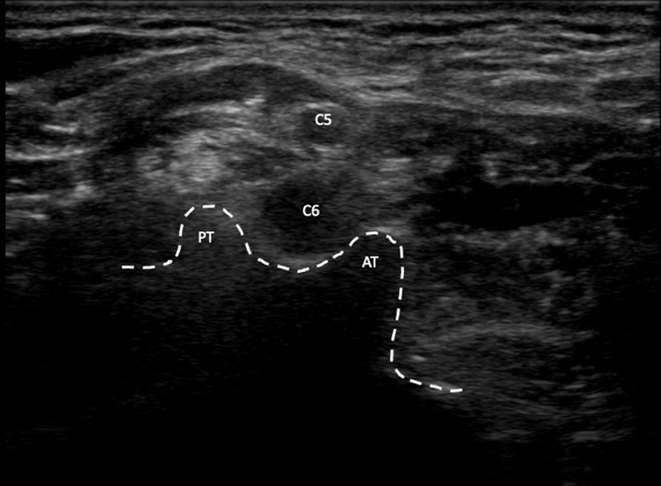 Complications of Cervical and Thoracic Transforaminal Epidural Block ...
