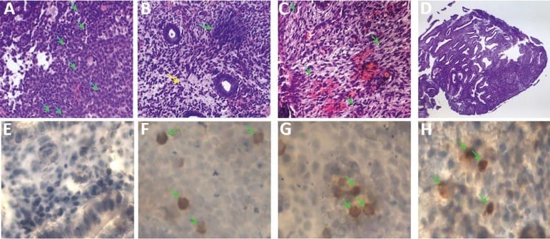 Management of Resistant Endometrium in Cases of Recurrent Implantation ...