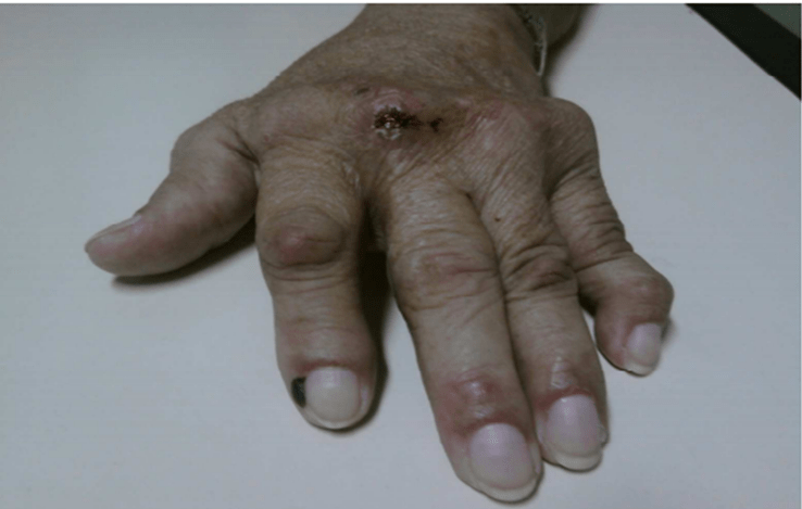 Rheumatoid Vasculitis: Heterogeneous Clinical Presentation - Athenaeum ...