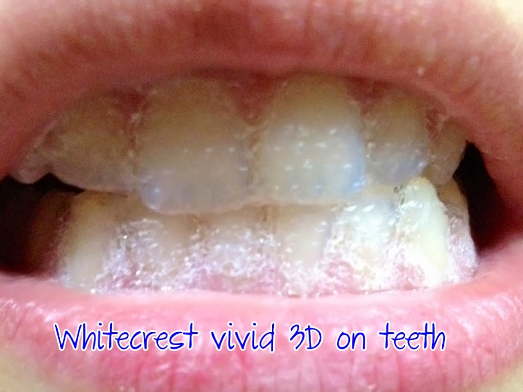 Crest Whitestrips -for whiter teeth-review | What to wear - Fashion Blog