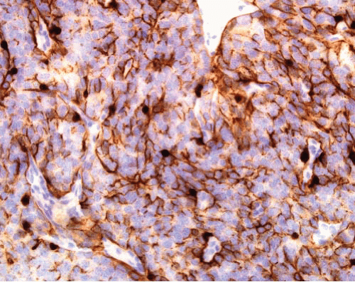 Small Round Cell Tumors | Basicmedical Key