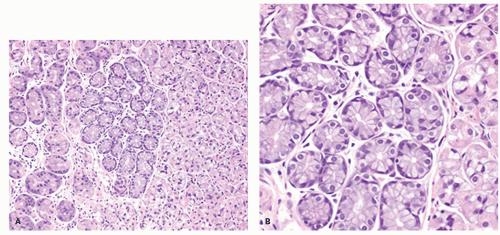 Gastric Epithelial Polyps and Tumors | Basicmedical Key
