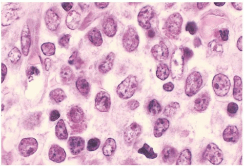 Acute Myeloid Leukemia | Basicmedical Key