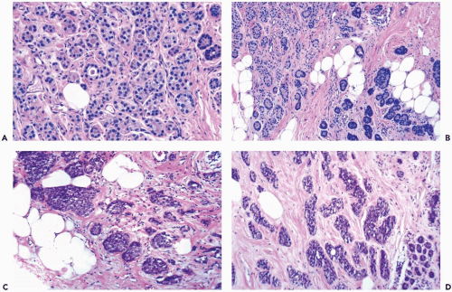 Adenosis and Microglandular Adenosis | Basicmedical Key