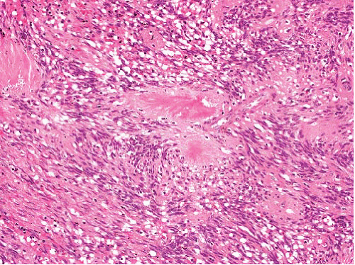Myofibroma, Myopericytic Tumors, Myoepithelioma, and Myofibroblastoma ...