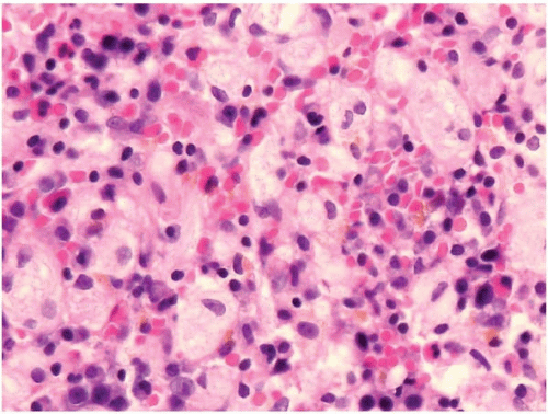 Monocytes, Histiocytes, and Storage Disorders | Basicmedical Key