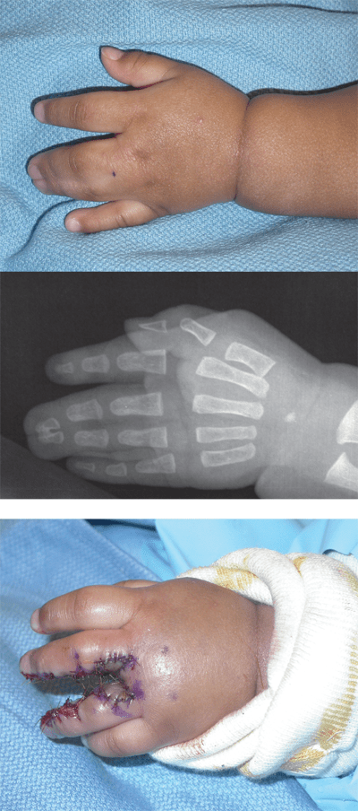 Surgery of the Hand and Wrist | Basicmedical Key