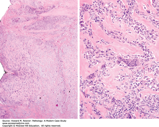 Soft Tissue and Bone Pathology | Basicmedical Key