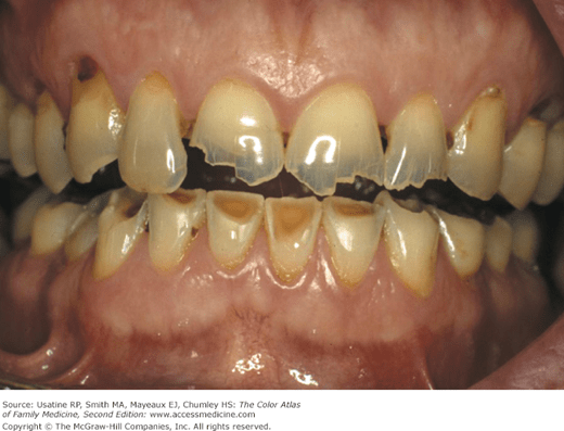 Adult Dental Caries | Basicmedical Key