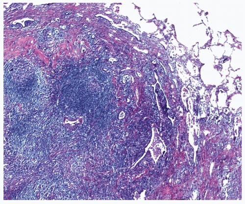 Fibrinous and Fibrous Pleuritis | Basicmedical Key