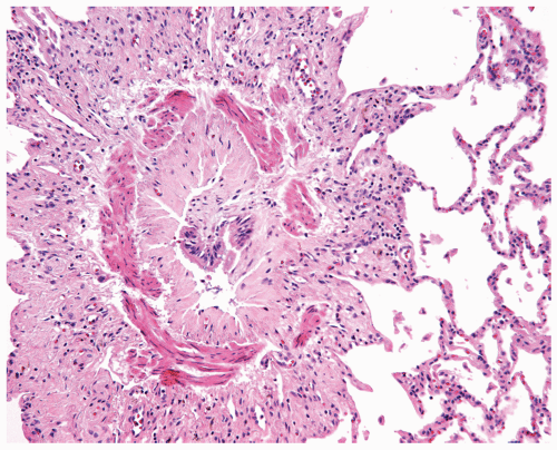 Diffuse Panbronchiolitis | Basicmedical Key