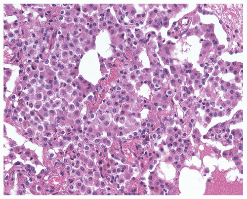 Desquamative Interstitial Pneumonia-Like Pattern | Basicmedical Key