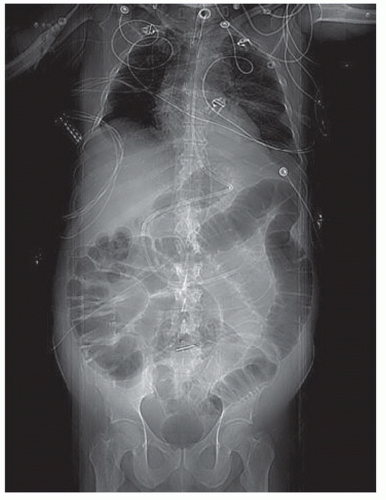 Nutrition in Pancreatic Diseases1 | Basicmedical Key