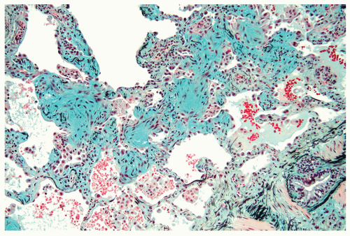 Diffuse Panbronchiolitis | Basicmedical Key