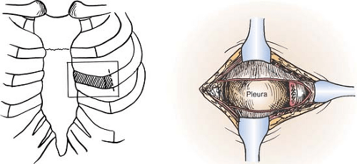 Mediastinoscopy and Mediastinotomy | Basicmedical Key