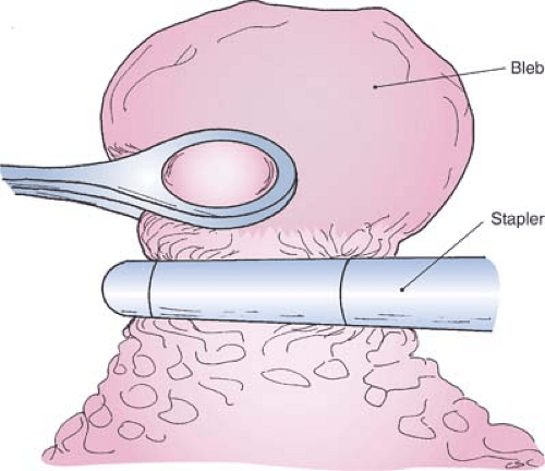 Thoracoscopy, Thoracoscopic Wedge Resection | Basicmedical Key