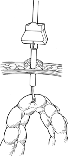 Laparoscopic Colostomy | Basicmedical Key