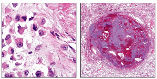 Ewing Sarcoma Primitive Neuroectodermal Tumor Pnet Basicmedical Key
