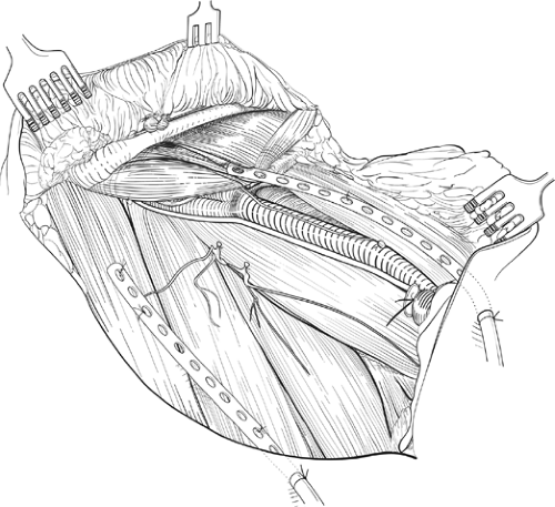 Neck Dissection | Basicmedical Key
