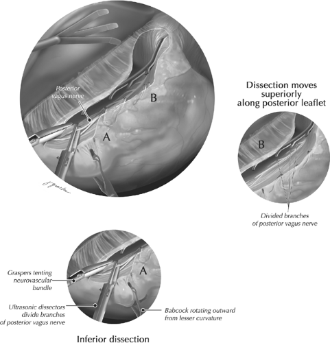 Selective Vagotomy and Pyloroplasty | Basicmedical Key