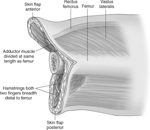 Major Lower Extremity Amputation | Basicmedical Key