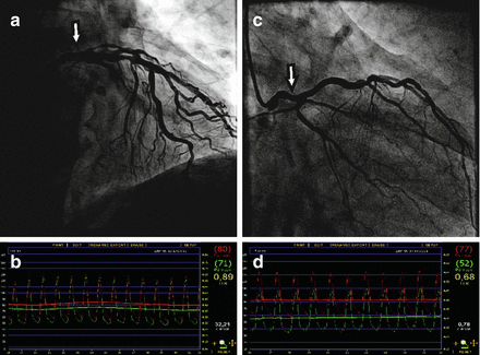 Medical Therapy Versus Revascularization in the Management of Stable ...