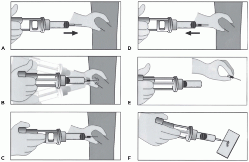 Fine-Needle Aspiration | Basicmedical Key