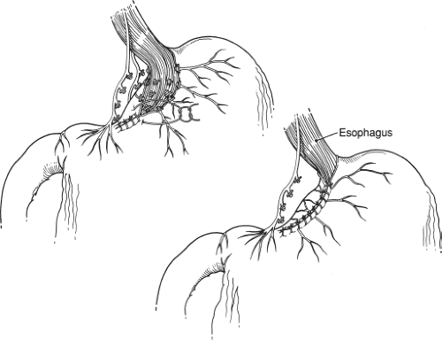 Truncal Vagotomy and Pyloroplasty and Highly Selective Vagotomy ...