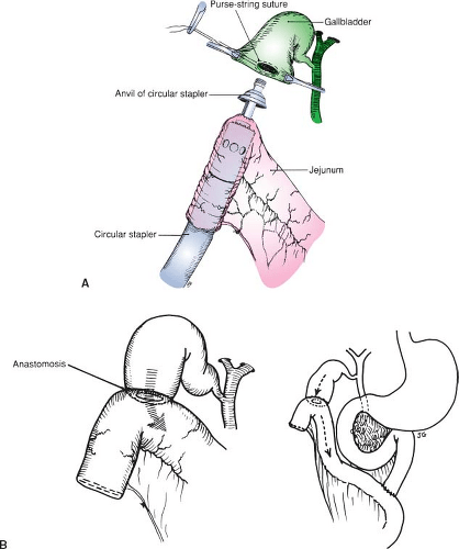Choledochoenteric Anastomosis by Choledochoduodenostomy and Other ...