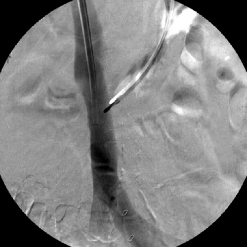 Insertion of Inferior Vena Cava Filters | Basicmedical Key