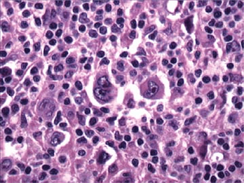 Post-Transplant Lymphoproliferative Disorders | Basicmedical Key