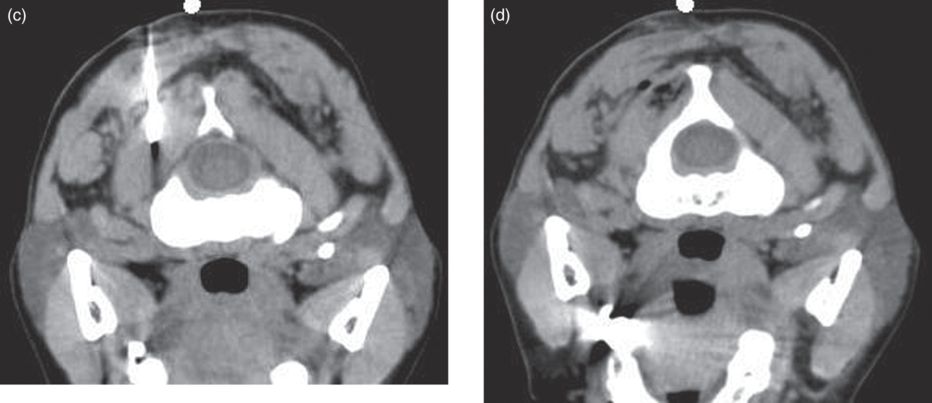 Examination and treatment of complex cervical dystonia | Basicmedical Key