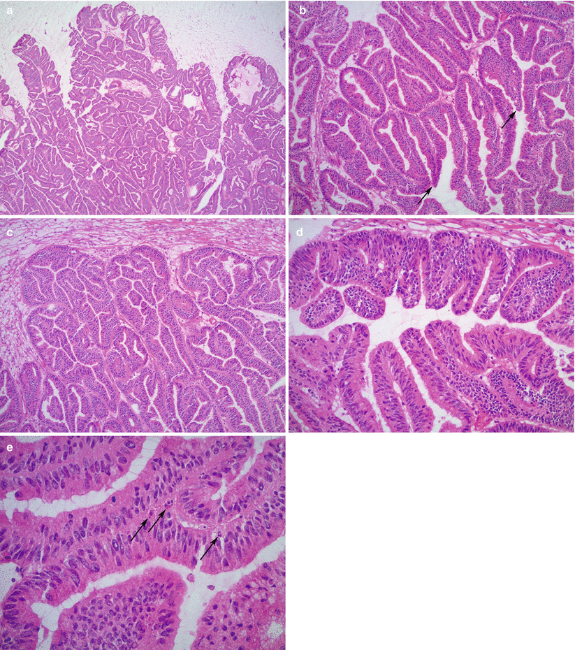 Ovarian Sex Cord Stromal Tumors Basicmedical Key