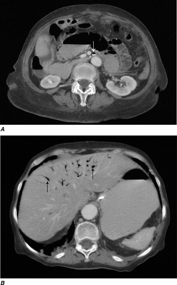 Cardiovascular Collapse, Cardiac Arrest, and Sudden Cardiac Death ...