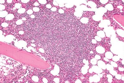 Disorders of Bone Marrow | Basicmedical Key