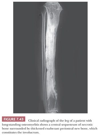 Nonneoplastic Diseases of Bones | Basicmedical Key