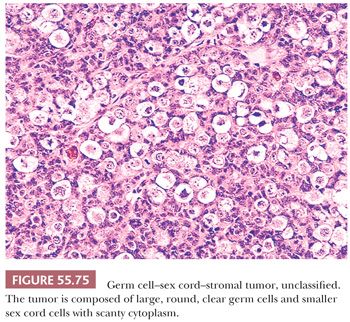 Sex Cord–Stromal, Steroid Cell, and Germ Cell Tumors of the Ovary ...